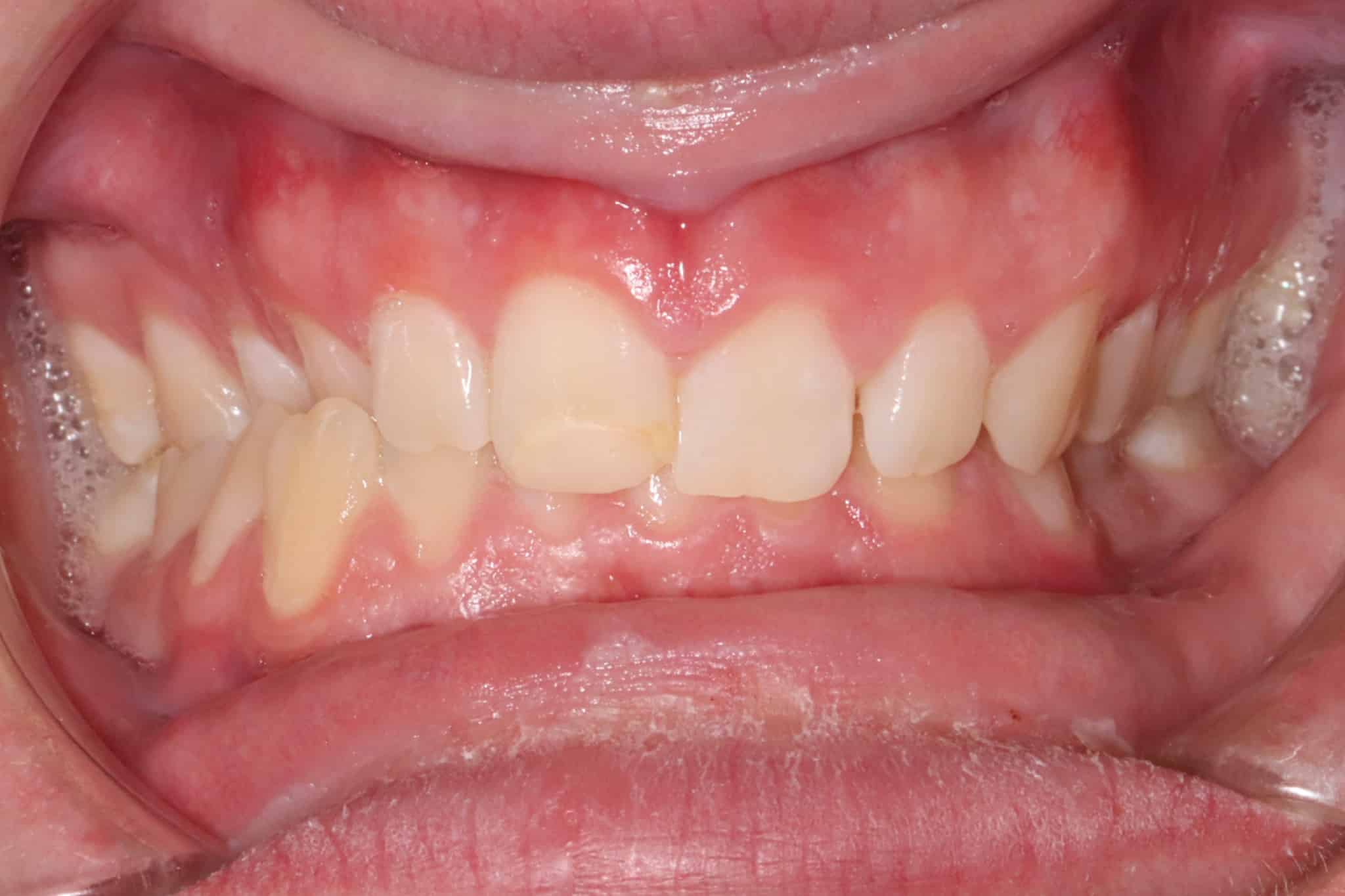 Common Orthodontic Problems Decatur IL | Hudson Orthodontics