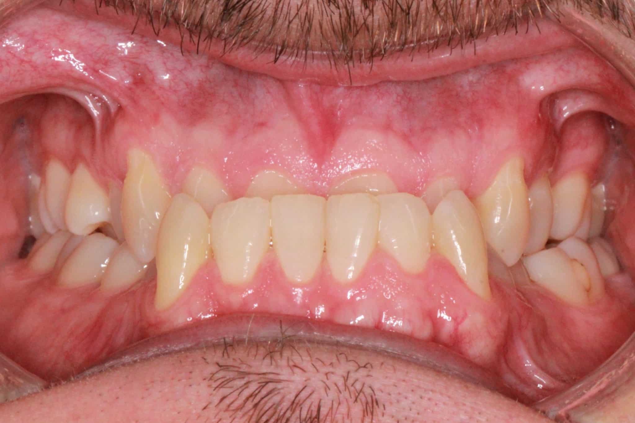 Common Orthodontic Problems Decatur IL | Hudson Orthodontics