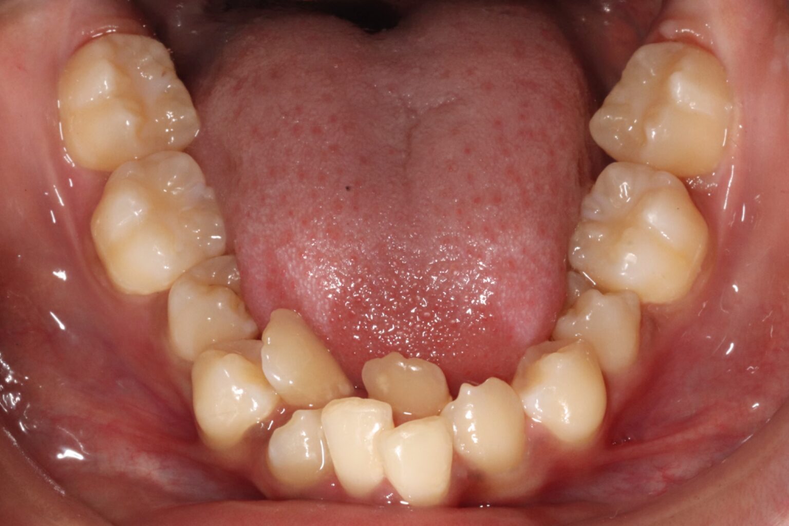 Common Orthodontic Problems Decatur IL | Hudson Orthodontics