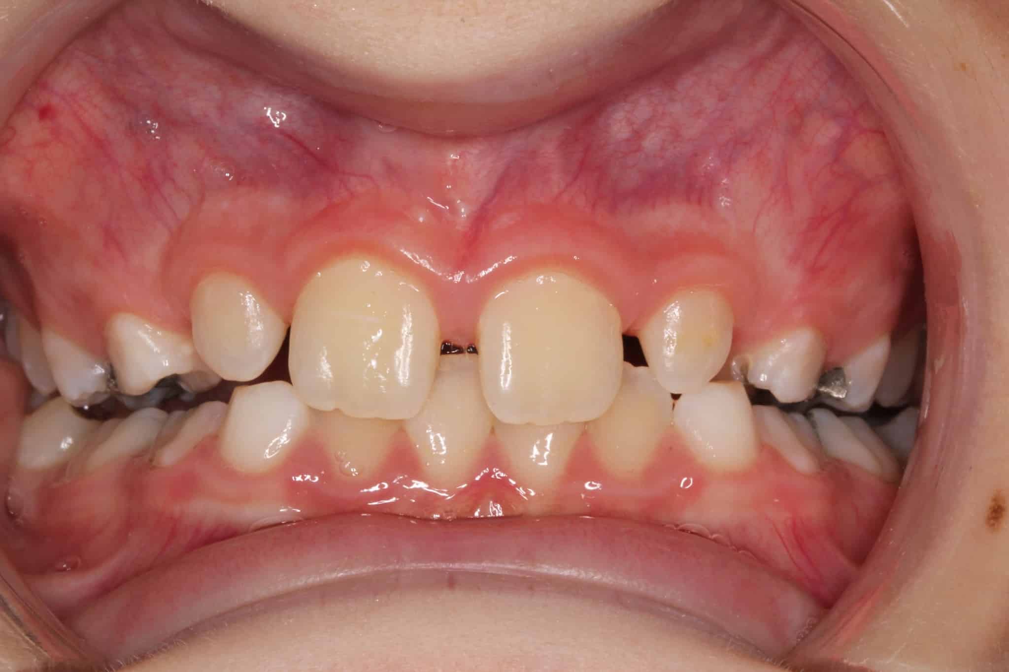 Common Orthodontic Problems Decatur IL | Hudson Orthodontics